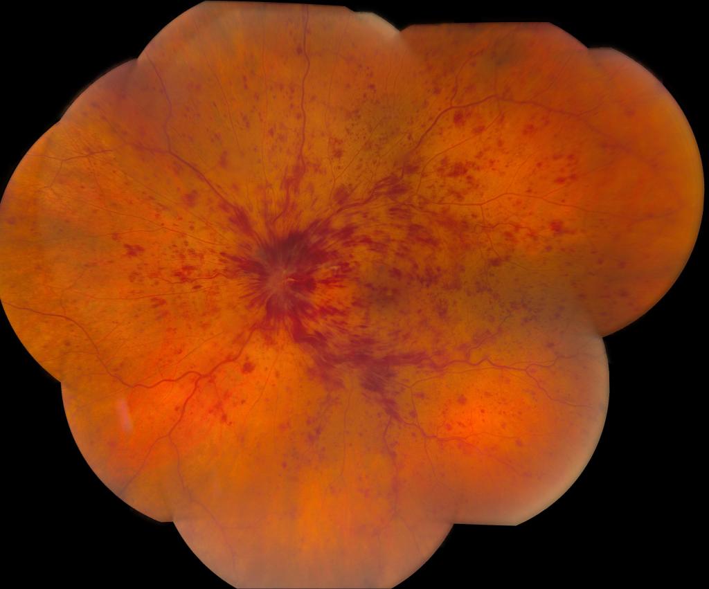 What Your High Blood Pressure Is Doing To Your Eyes | Optometrist ...