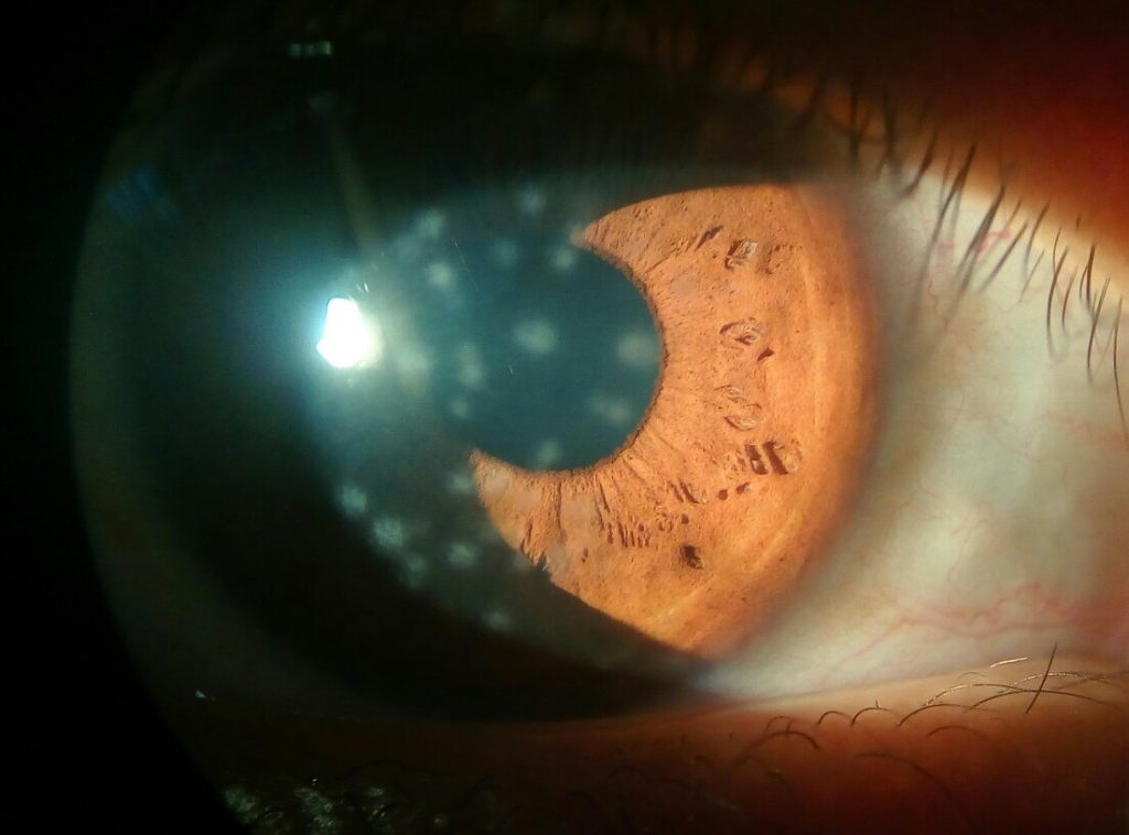 Adenoviral keratitis Optometrist Paducah Kentucky Eye Doctor Paducah KY